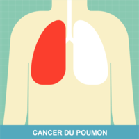 Cancer du poumon : points-clés | Santé.fr