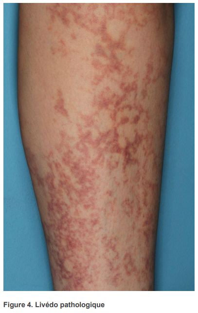 Lésions cutanées dans le contexte des symptômes prolongés de la Covid ...