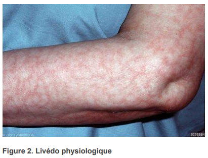 Lésions cutanées dans le contexte des symptômes prolongés de la Covid ...