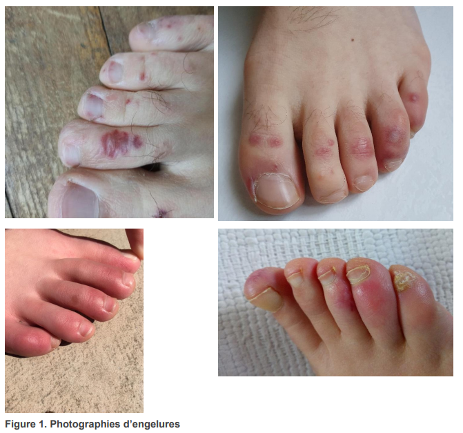 Lésions cutanées dans le contexte des symptômes prolongés de la Covid ...